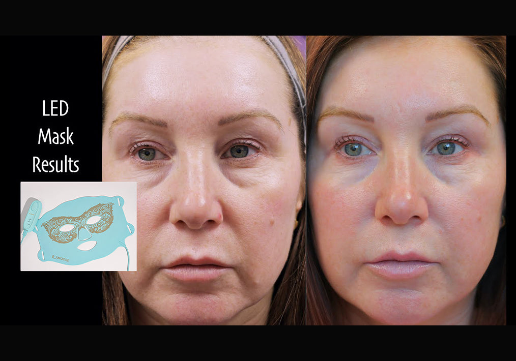 Are LED Therapy Results Really Temporary? Here's What You Need to Know ...